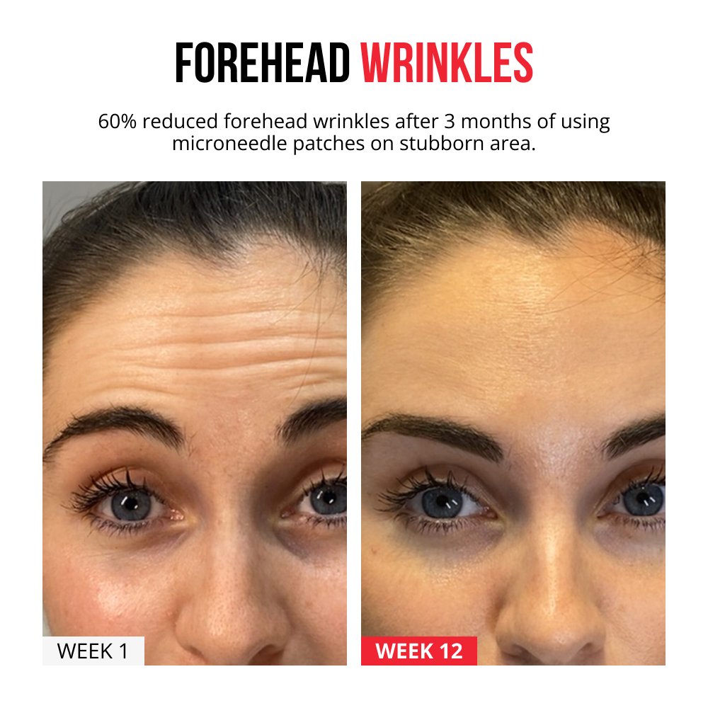 Self-dissolving Microneedle Patches – SWISS+POWER